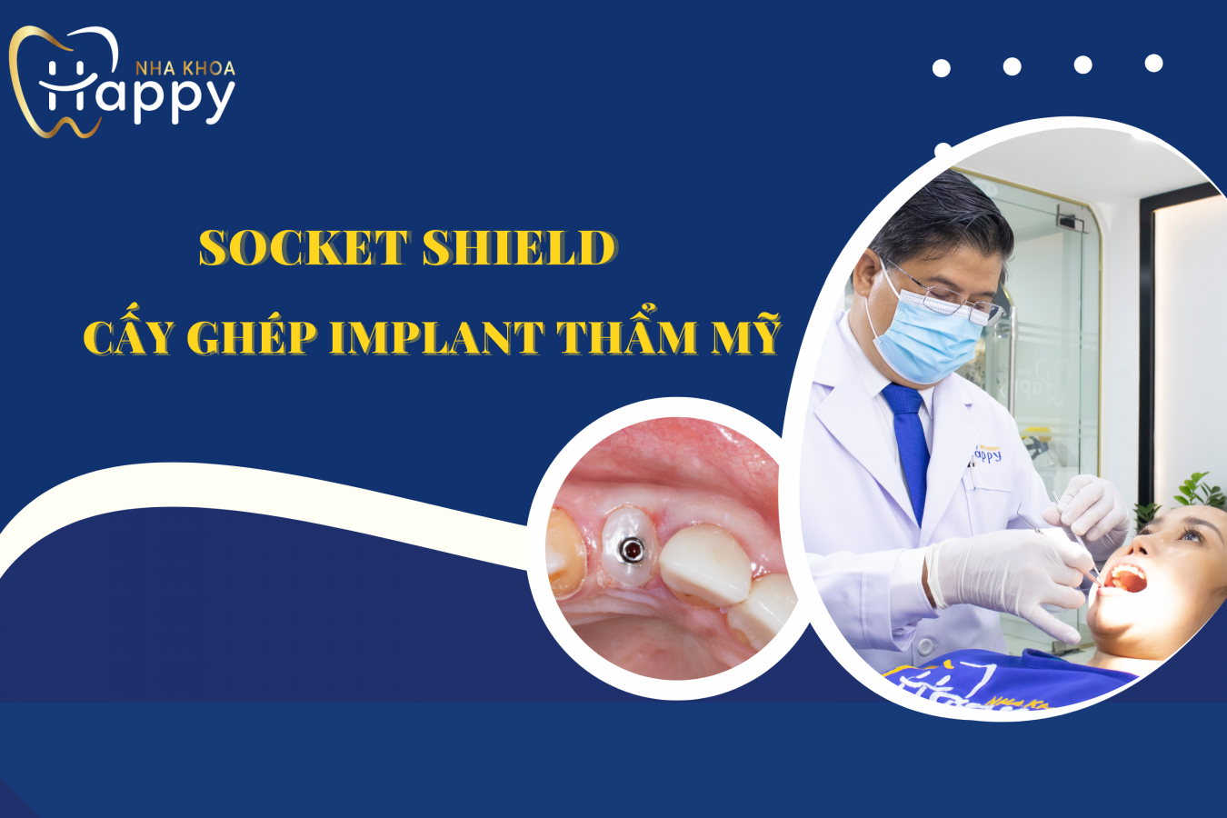 5 Sự thật về Socket Shield kĩ thuật mới cấy ghép Implant